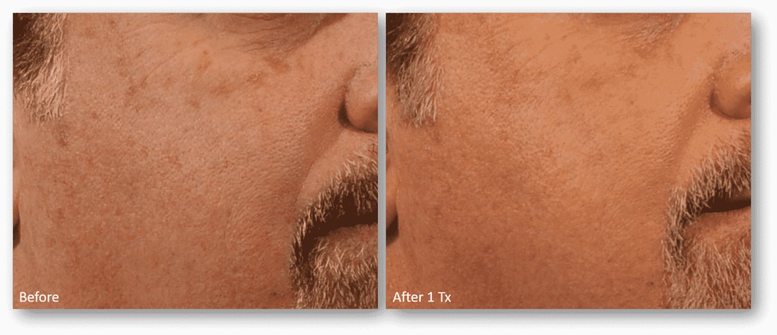 Avissa Skin | Lutronic LaseMD Ultra