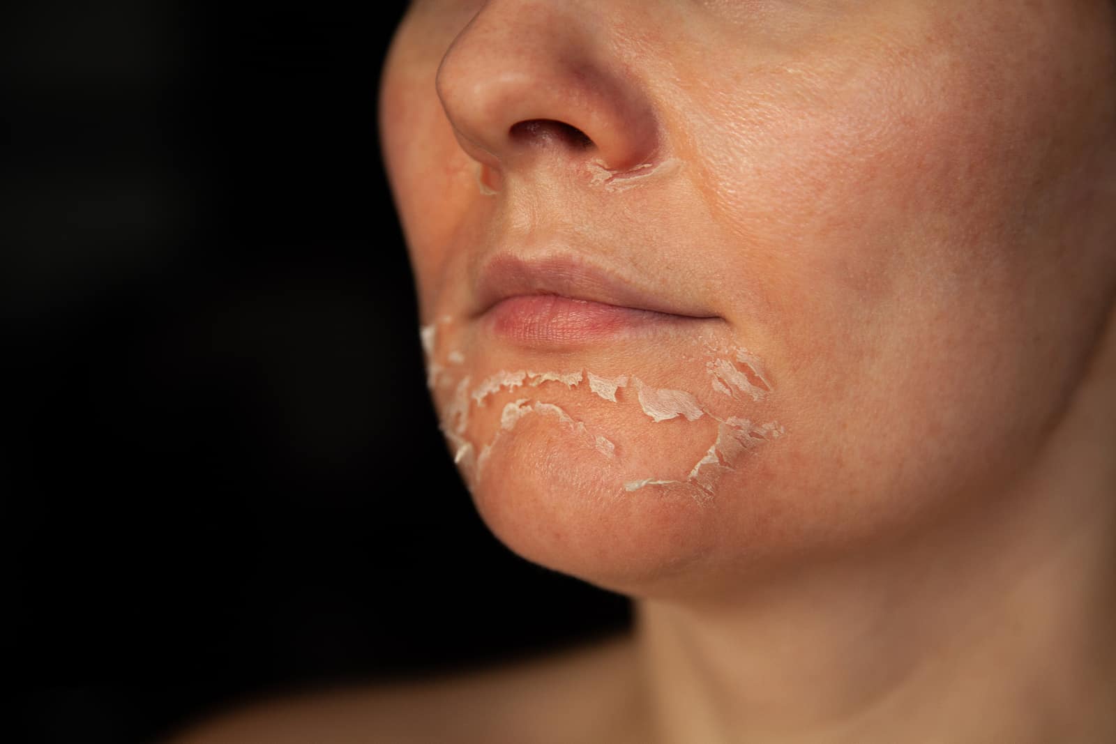 Avissa Skin Chemical Peels Avissa Skin Chemical Peels